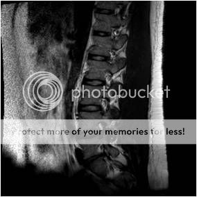 Another back pain thread - pictures of my MRI - just got them ...